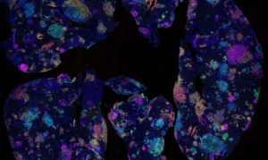Australian study identifies early blood marker for lung cancer risk ...